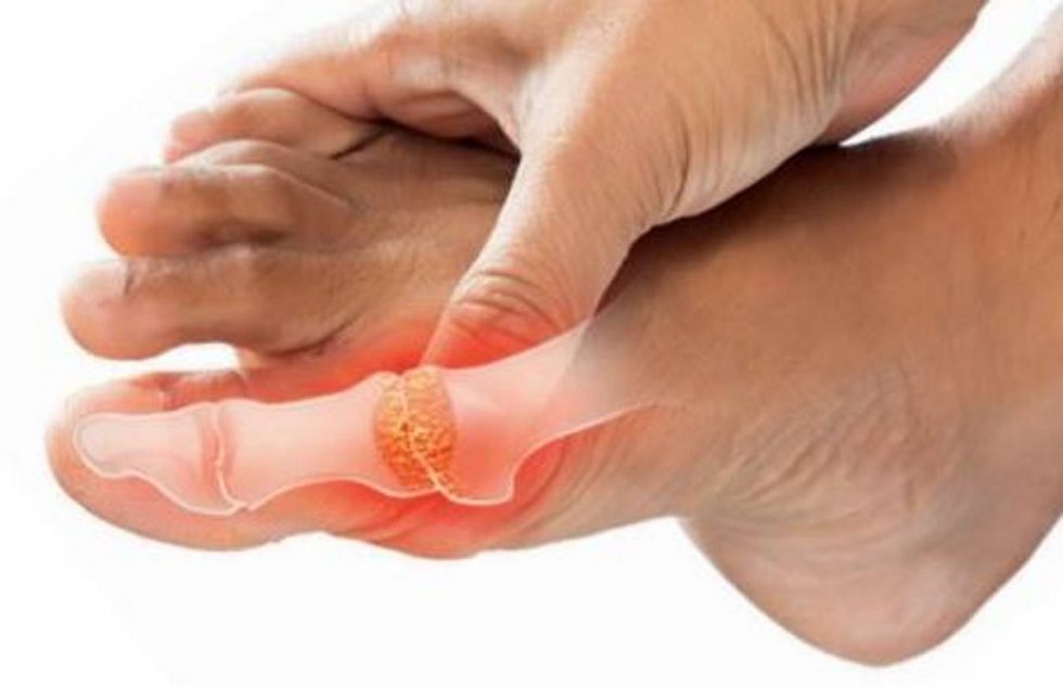 Podagra: Harnsäure-Alarm im großen Zeh - Podologie