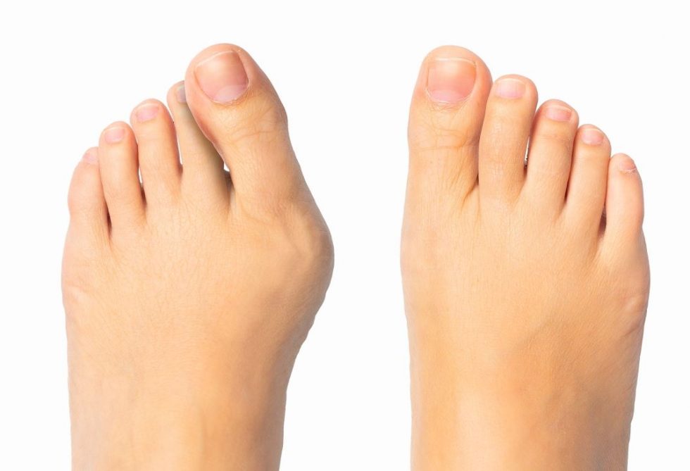 Zehenfehlstellungen - mehr als ein ästhetisches Problem - Podologie