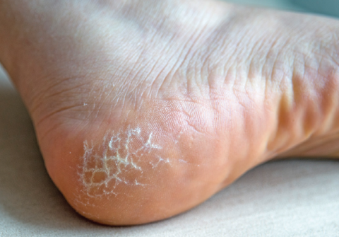 Hilfe bei Rhagaden - Podologie