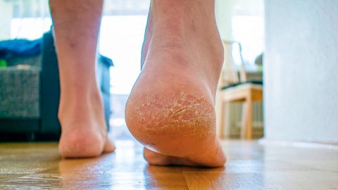 Hilfe bei Rhagaden - Podologie