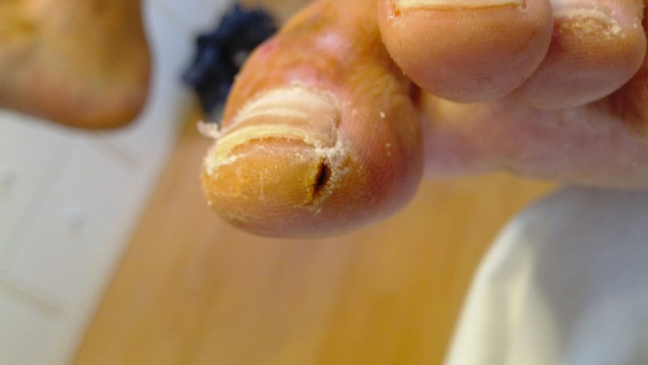 Schmerzhaft und hartnäckig: Rhagaden und Schrunden - Podologie